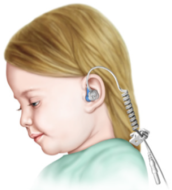 For Physicians | Tula System for In-Office Tympanostomy